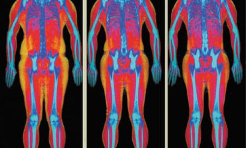 Densitometria ossea DEXA – Centro Medico Diagnostico Optimum